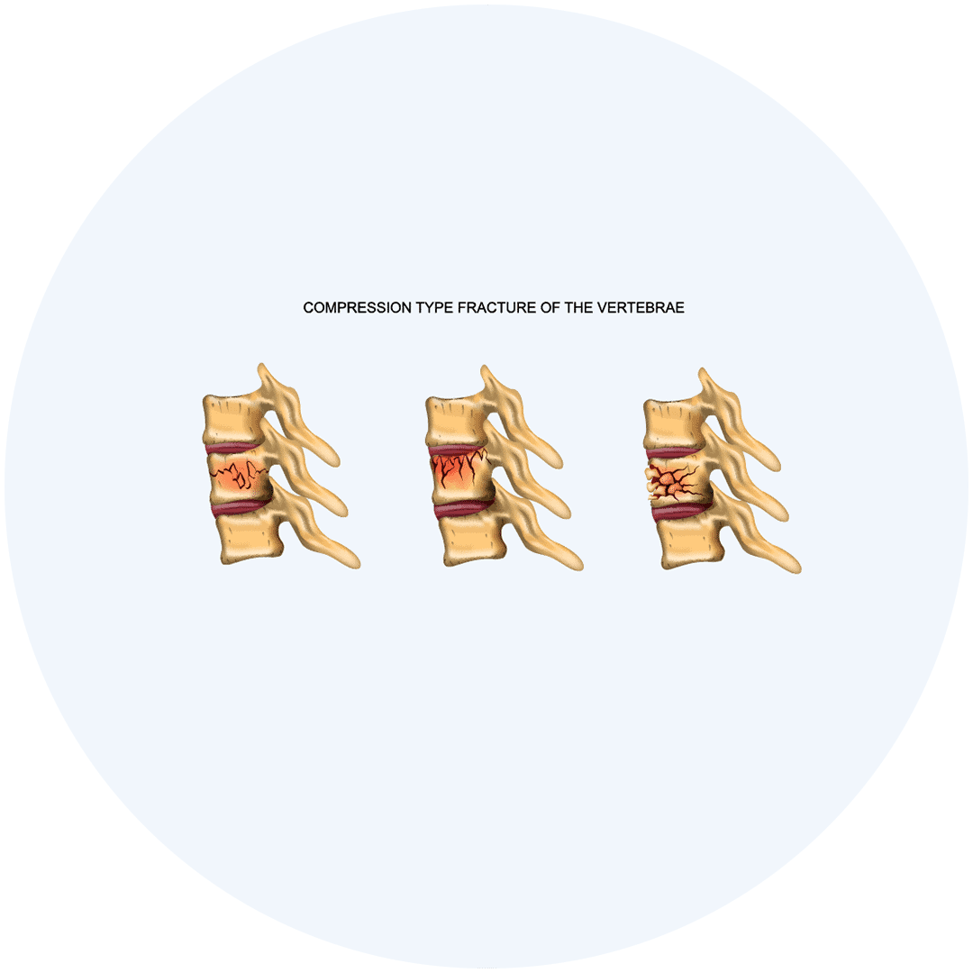 What Causes Lower Back Pain | Spine Team Texas