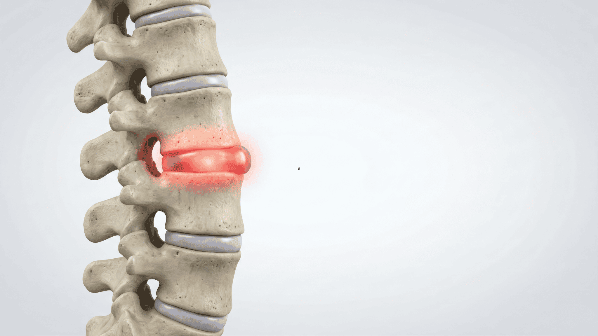 Bulging and Herniated Discs: Key Differences Explained | Spine Team Texas